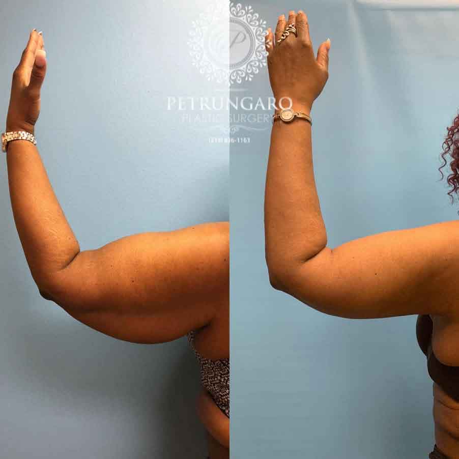 Liposuction Before And After Arms Liposuction Before And After Arms