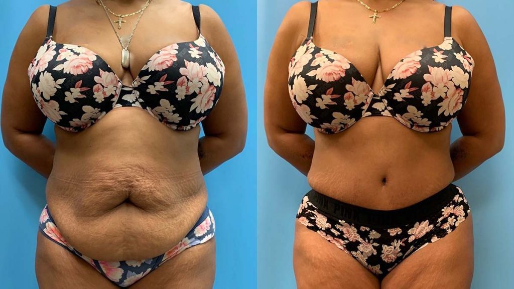 Tummy Tuck Chicago NW Indiana, Costs | Petrungaro Plastic Surgery